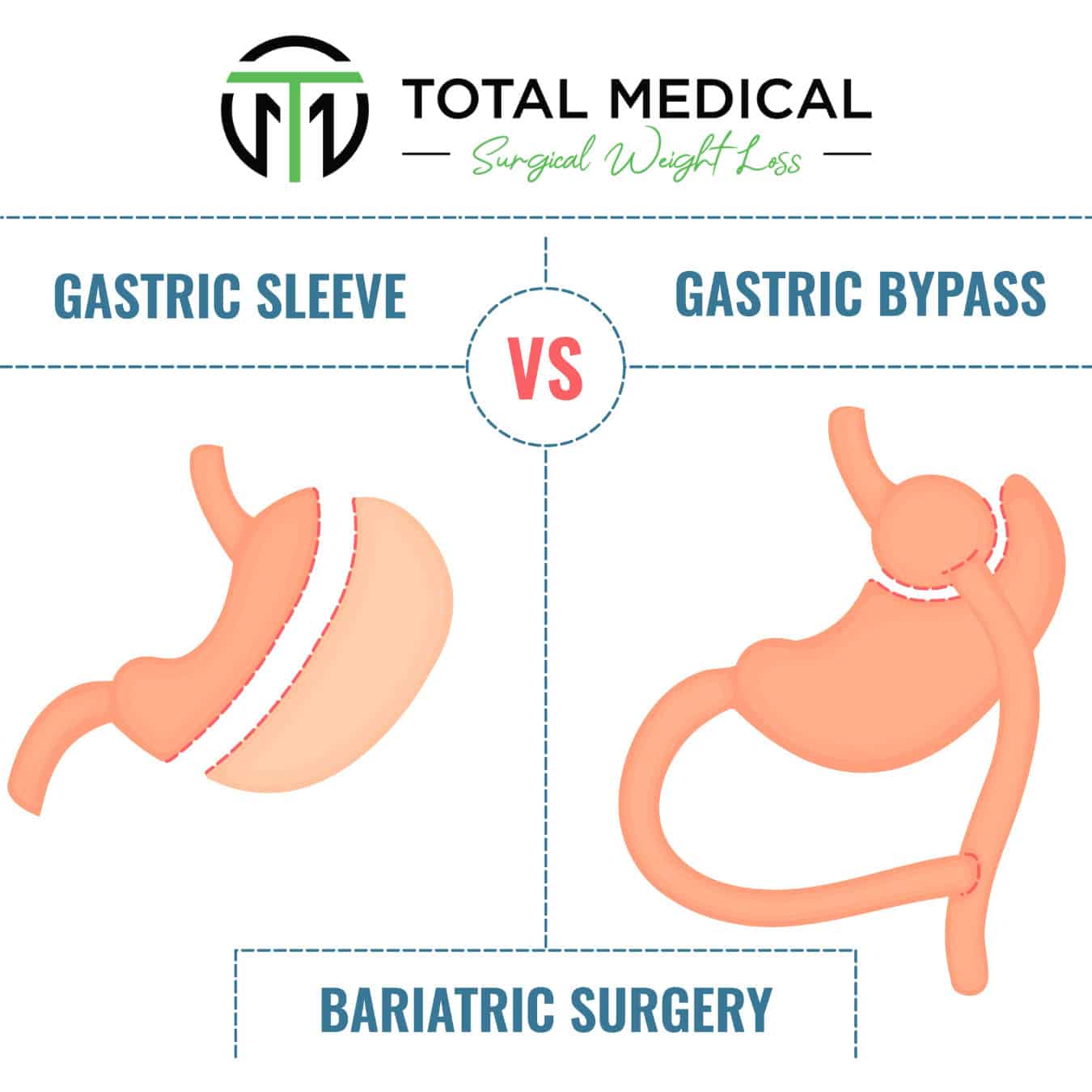 Gastric Bypass V Sleeve Gastrectomy Important Considerations